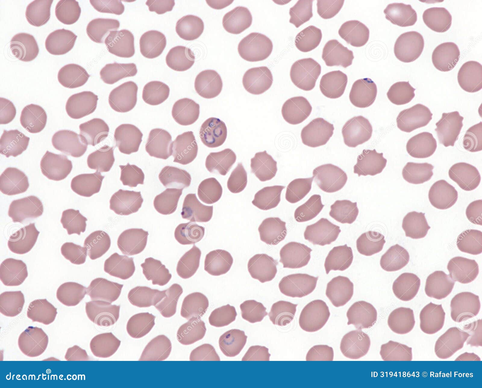 Malaria.Ring Forms of Plasmodium Falciparum in Peripheral Blood. Stock ...