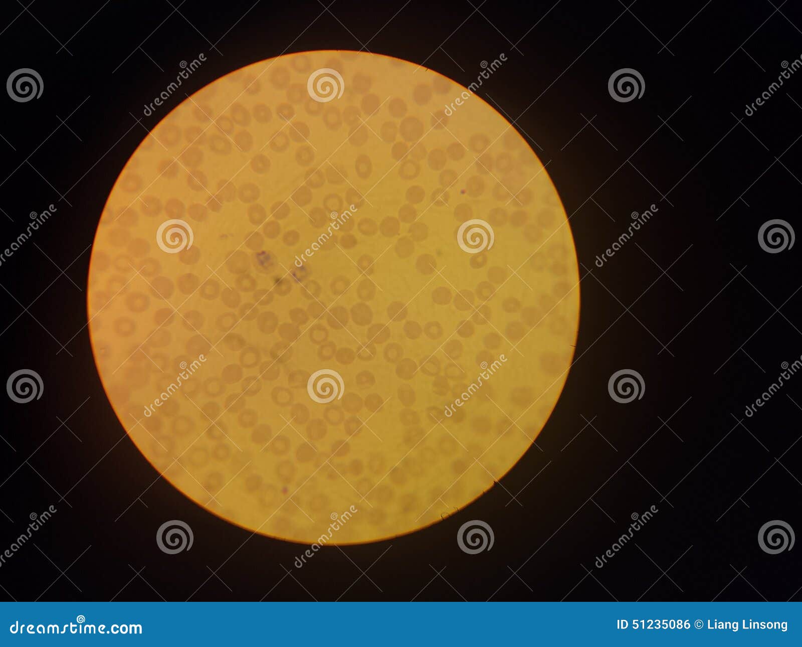 Malaria under microscope stock photo. Image of health - 51235086