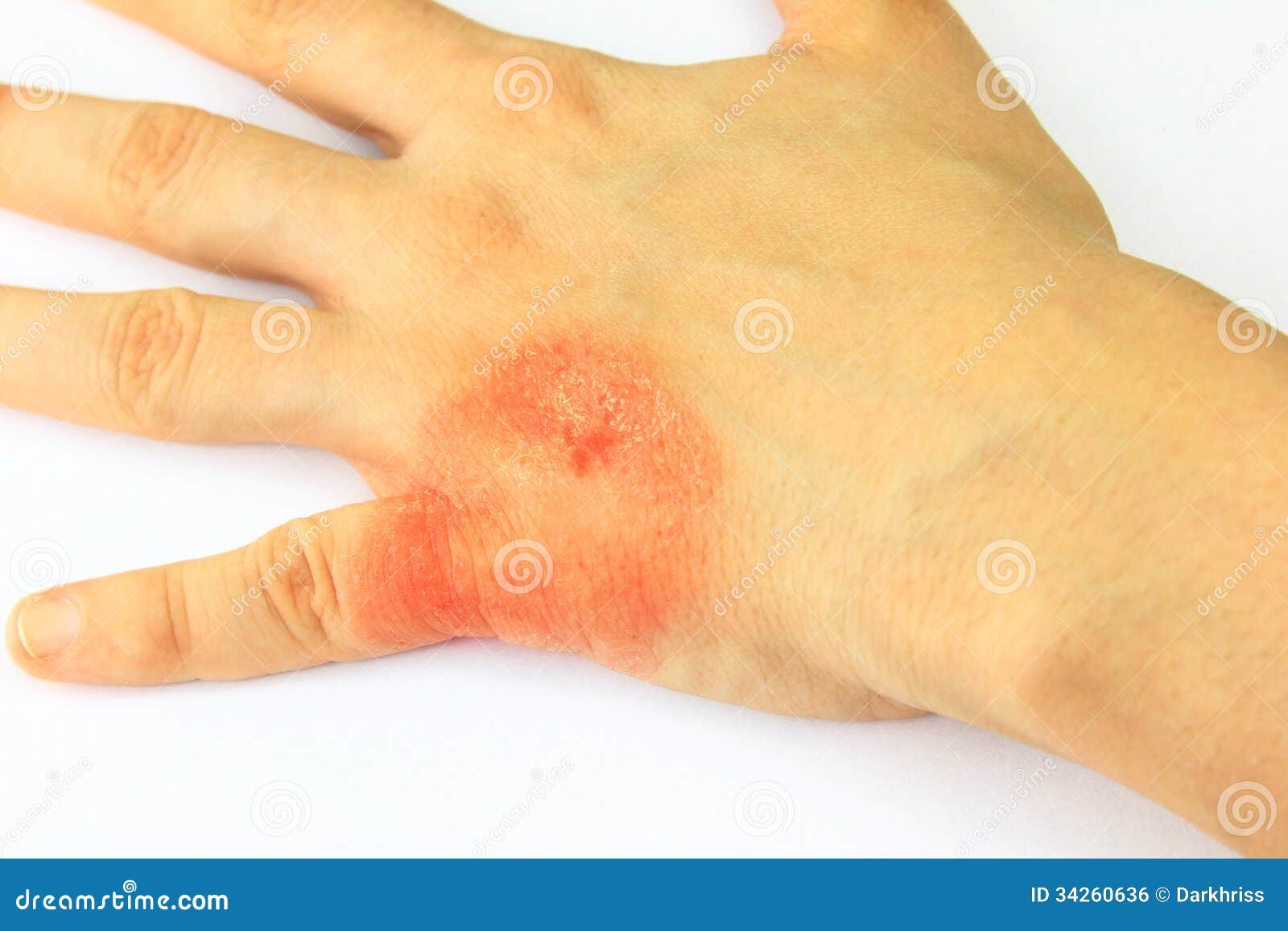 Malattia della pelle fotografia stock. Immagine di allergia - 34260636