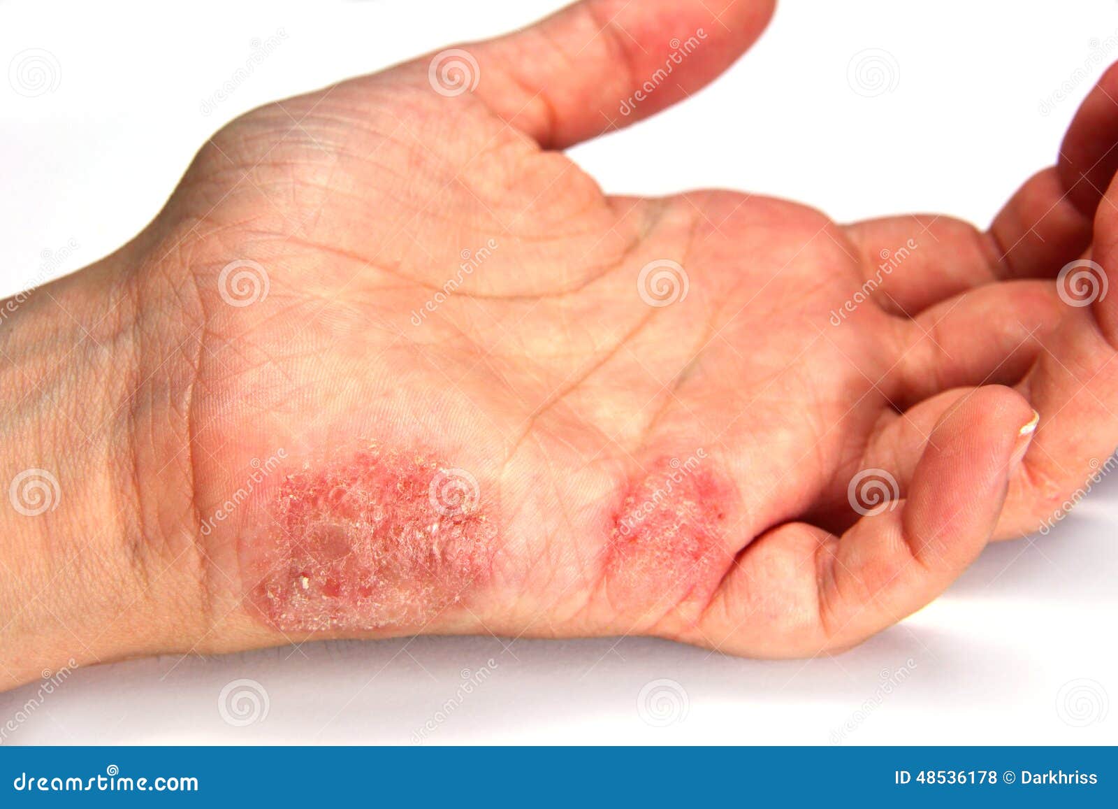 Malattia della pelle fotografia stock. Immagine di doloroso - 48536178