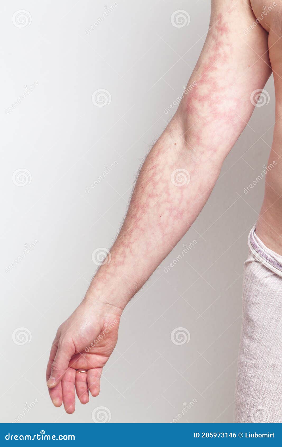 Male Arm with Red Skin Capillary Network Stock Photo - Image of ...