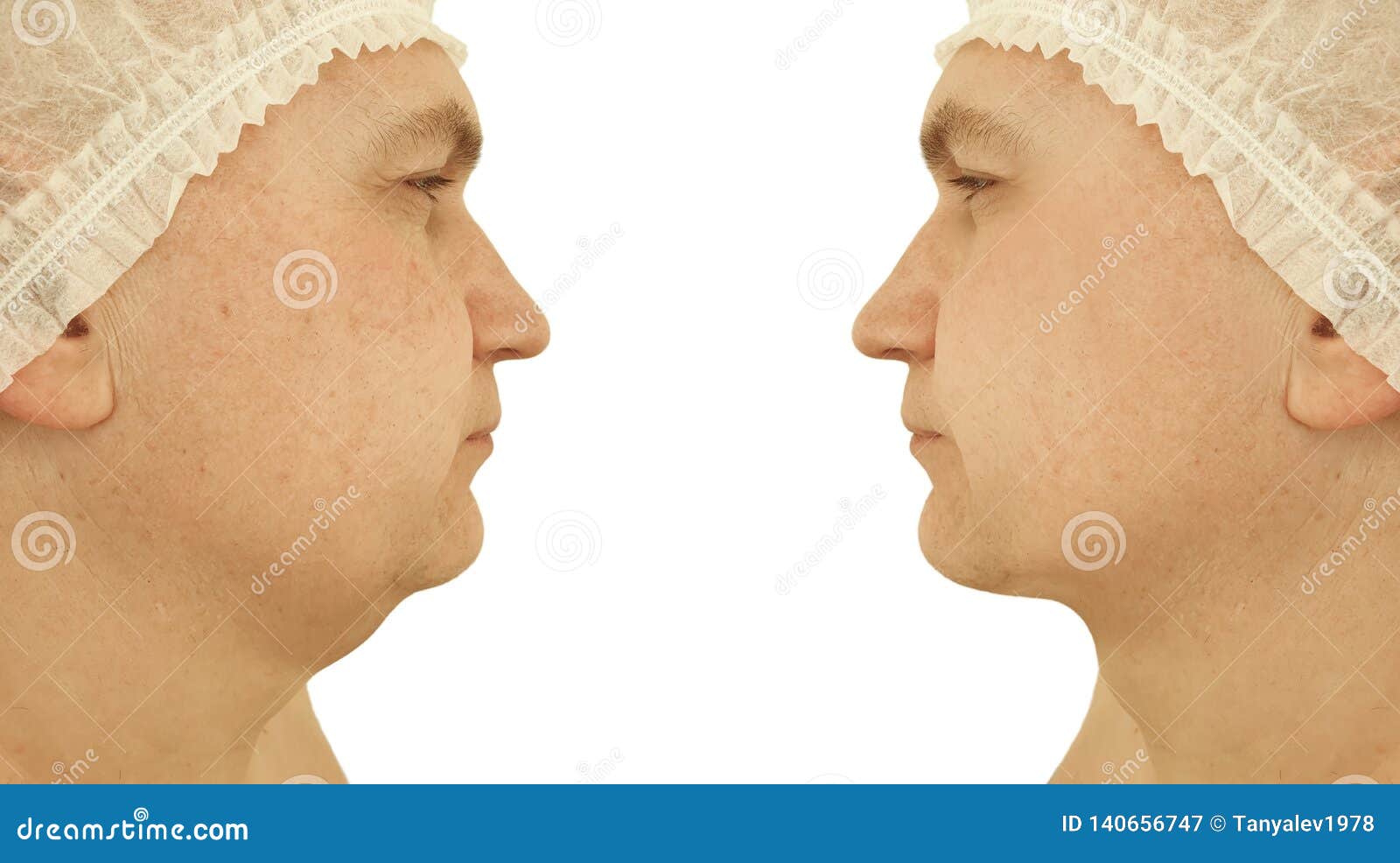 Male Double Chin Before And After Treatment Liftingsagging Royalty-Free ...