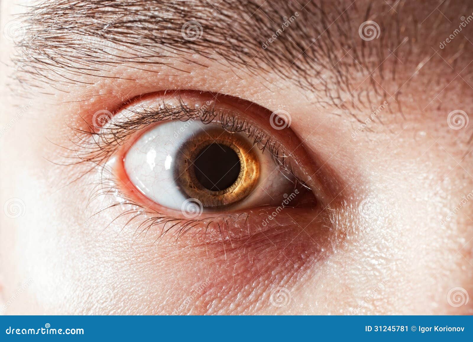 Male Eye with Mydriatic Pupil Stock Image - Image of mydriatic ...