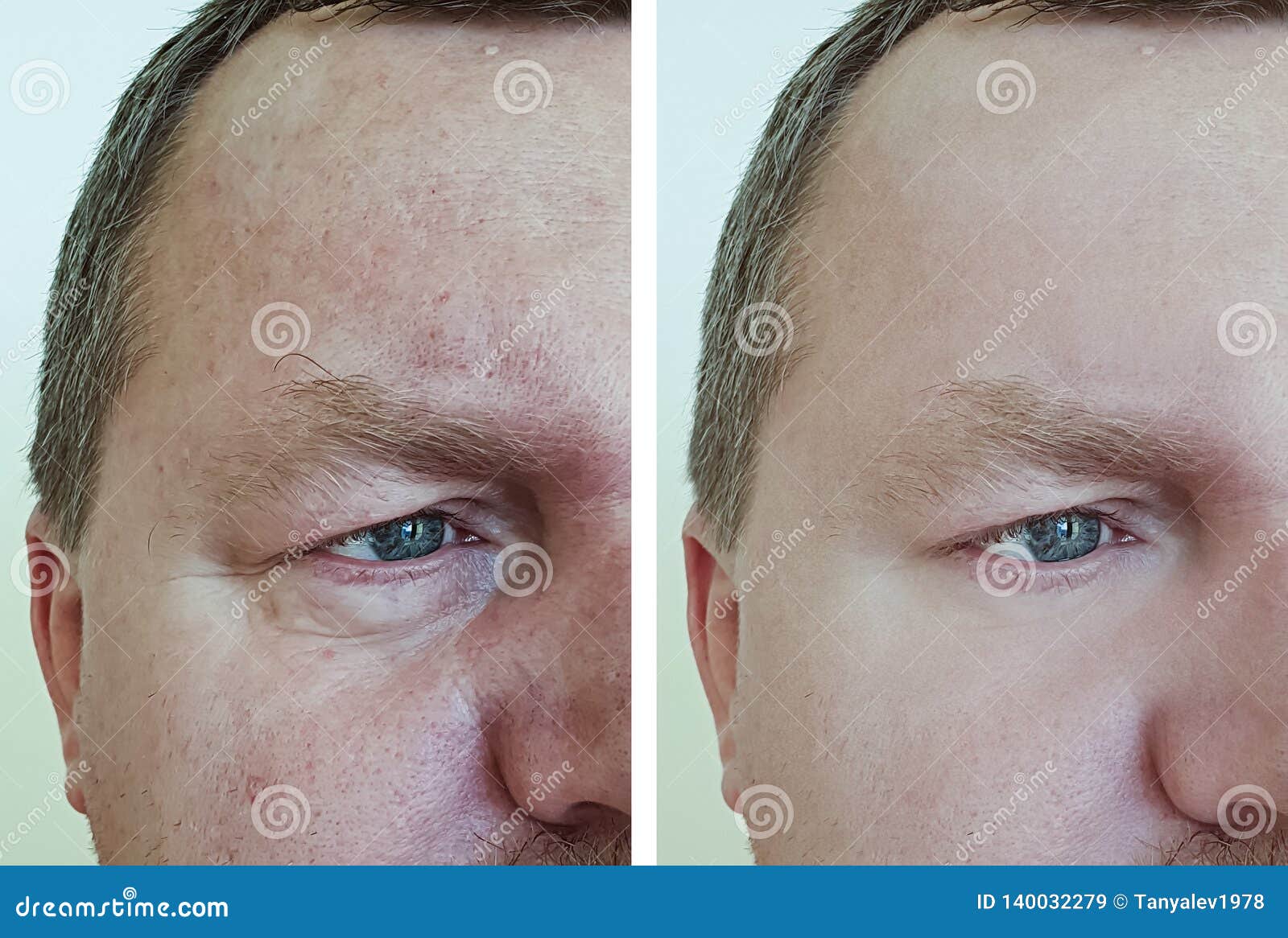 Male Eye Wrinkles before after Procedures Stock Image - Image of aging ...