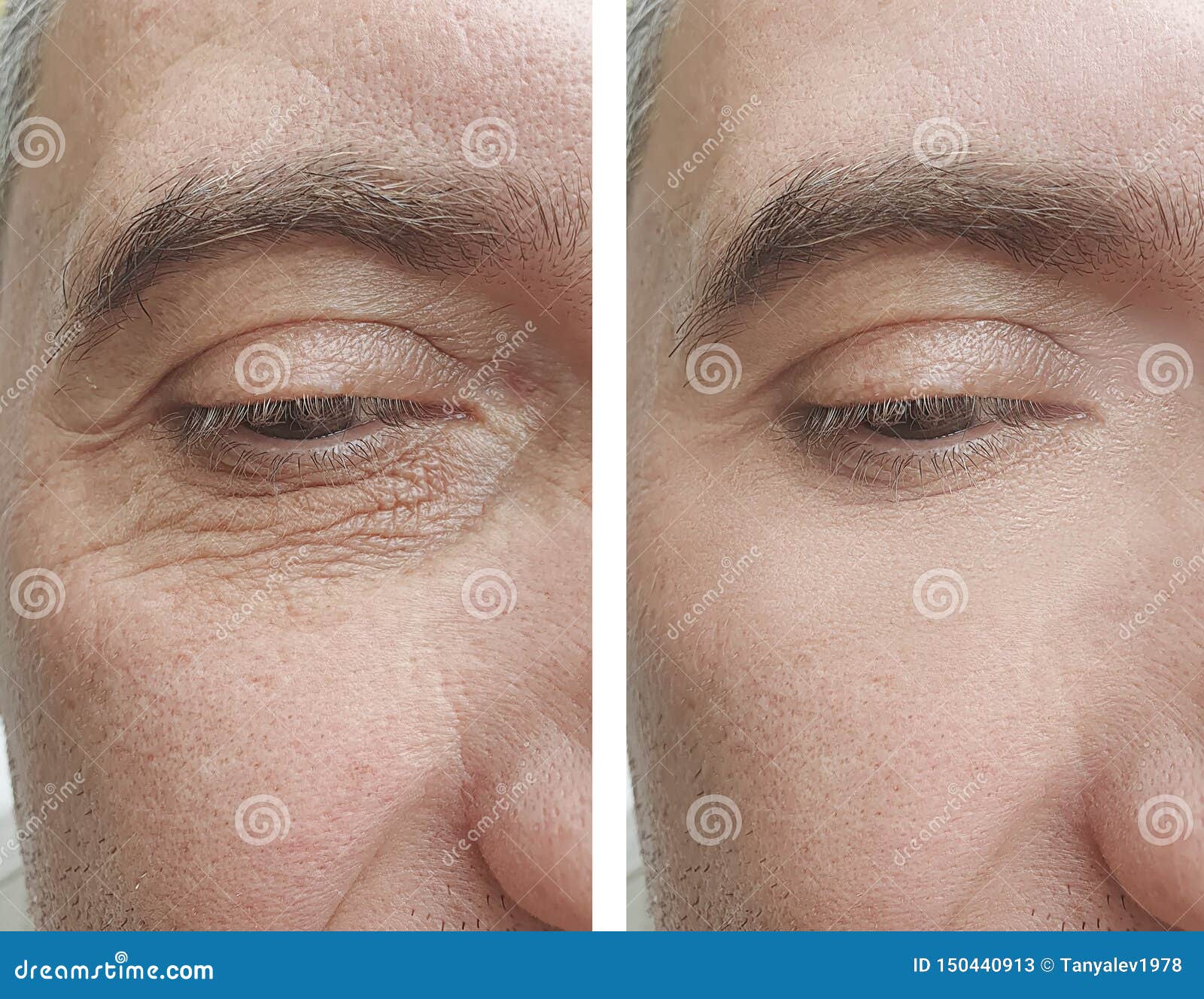 Male Face Removal Wrinkles Effect Biorevitalization Before And After