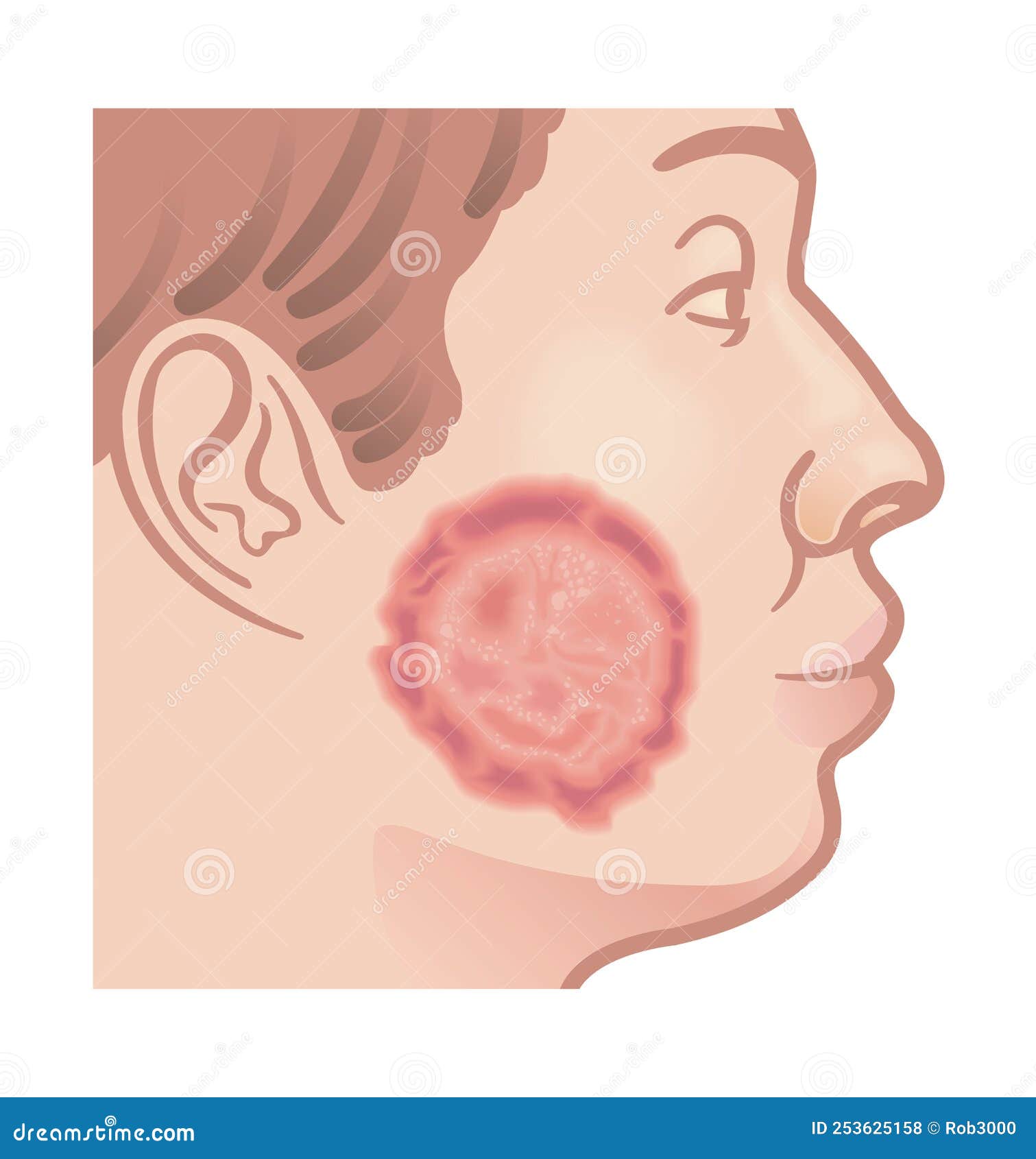 Dermatophytosis Or Ringworm Is Fungal Infection Cartoon Vector ...