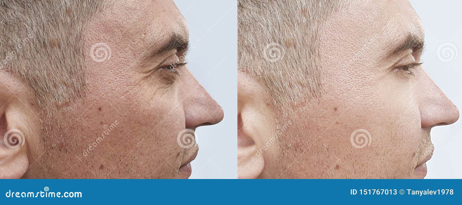 Male Face Wrinkles before and after Treatment Effect Stock Image ...