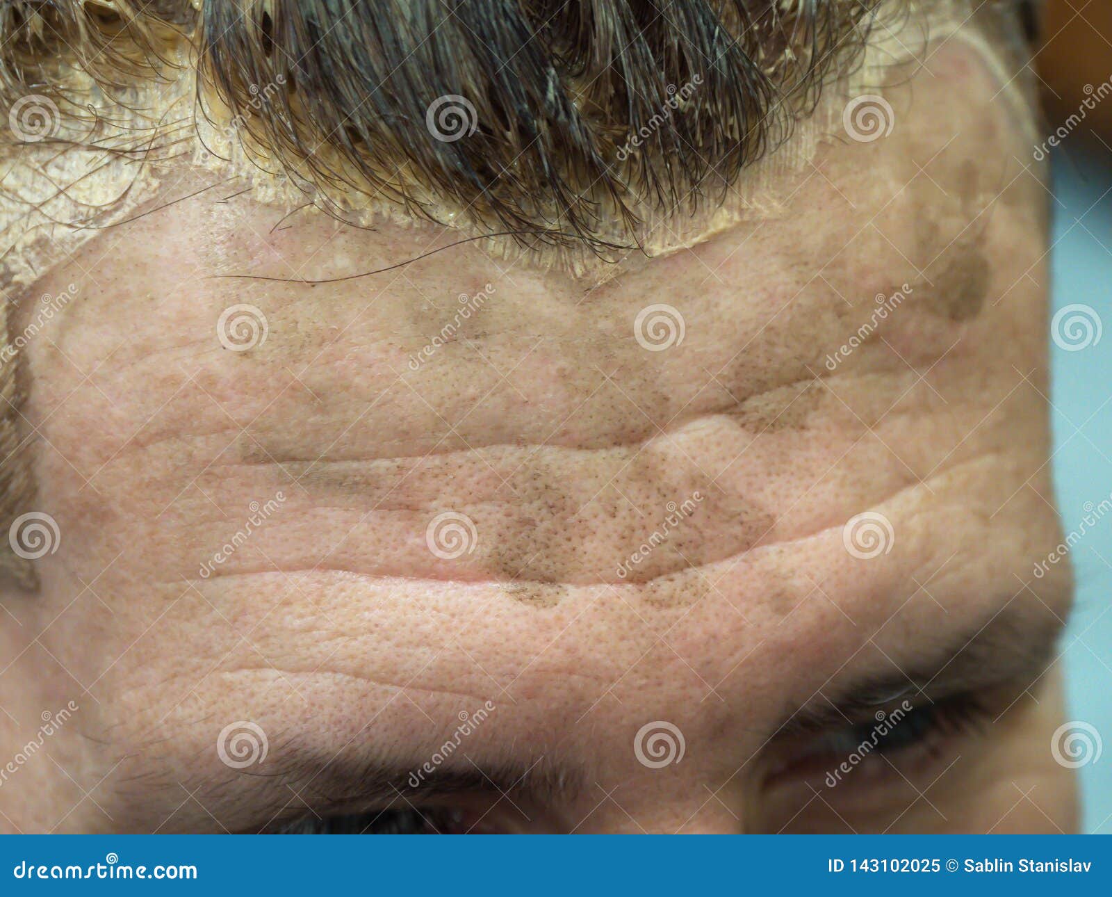 Male Forehead Stained during Hair Coloring. Stock Image - Image of male ...