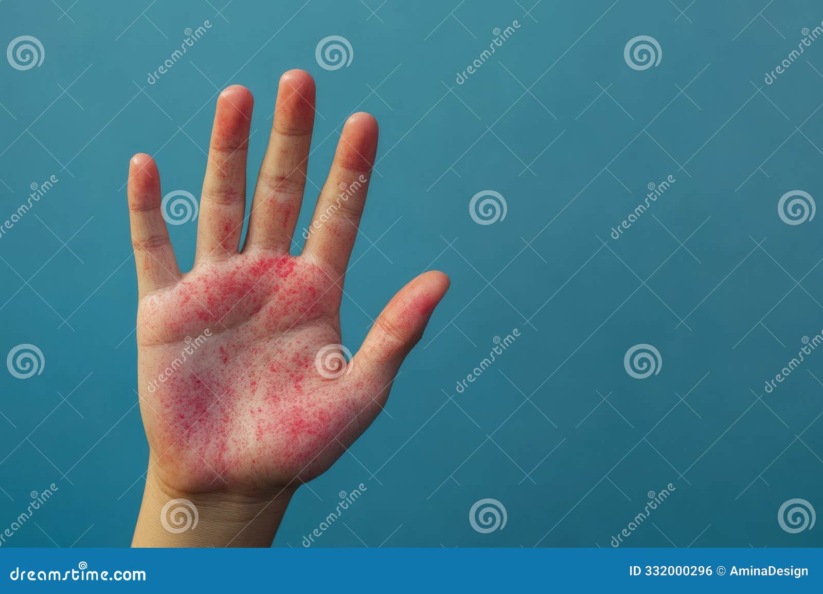 Male Hand with Rash this May Be a Possible Indicator of a Viral ...
