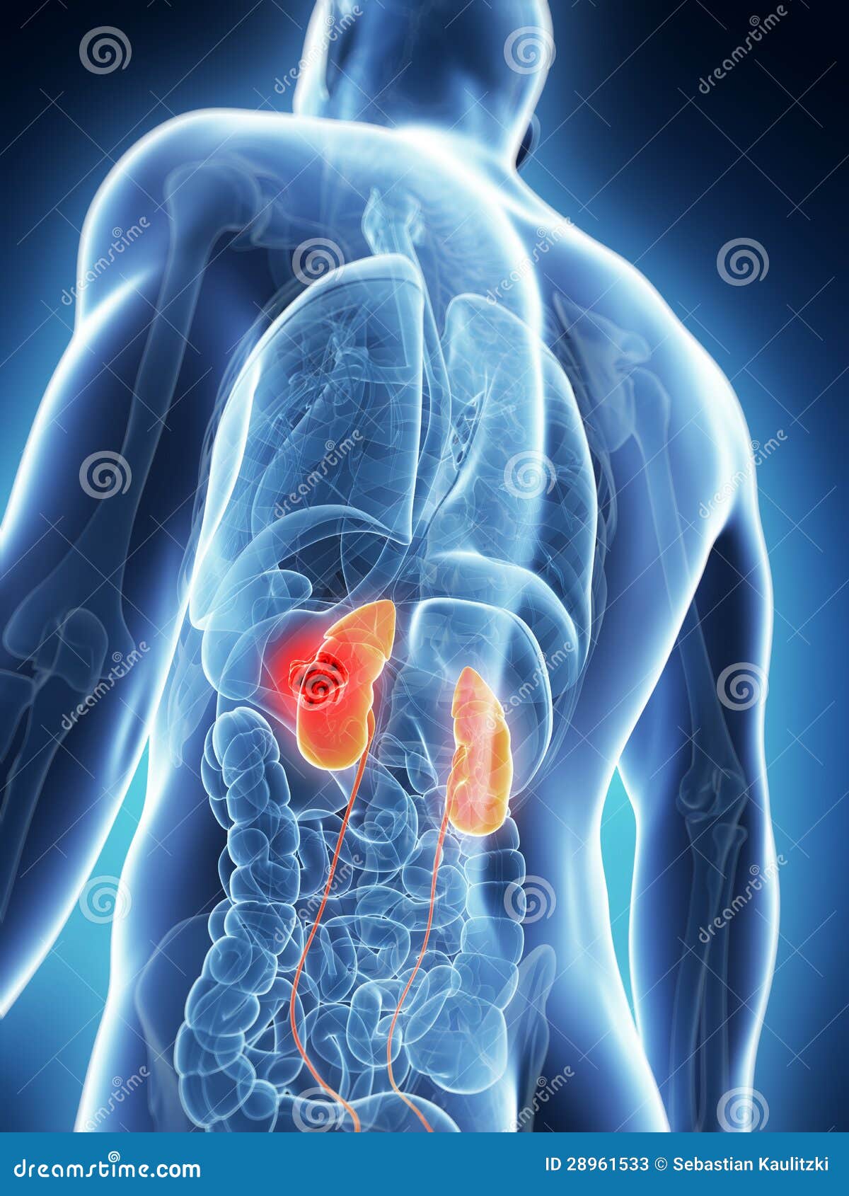 Male kidneys - cancer stock illustration. Illustration of sick - 28961533
