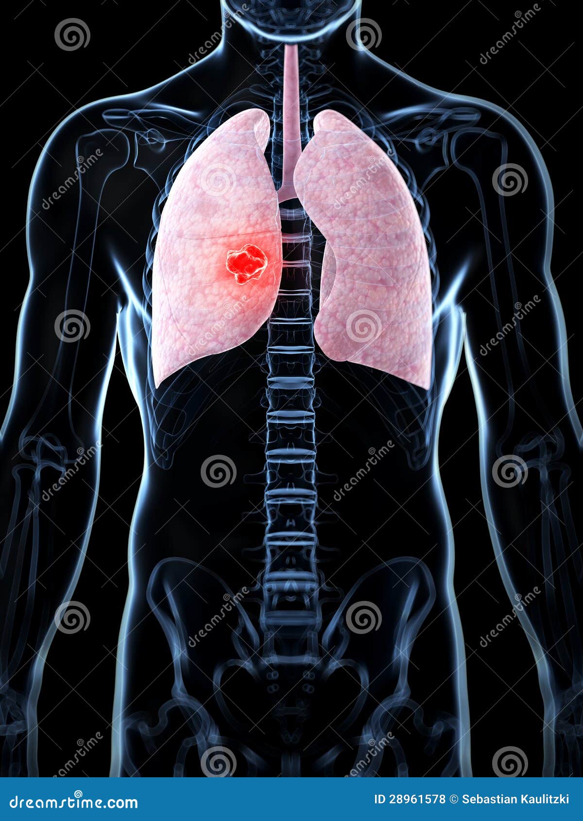 Lung Abscess Microbial Infection Of The Lung Causing Necrosis Of The Pulmonary Vector