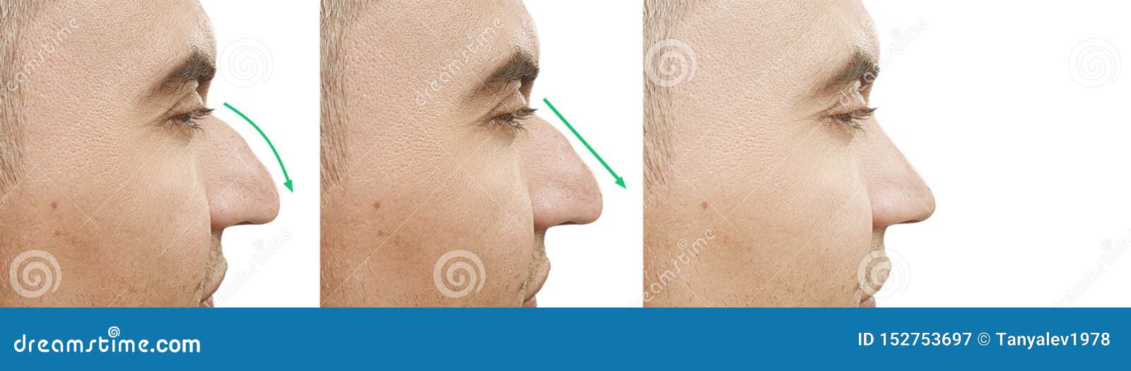 Male Nose Hump Problem Before And After Treatment Procedure Difference ...