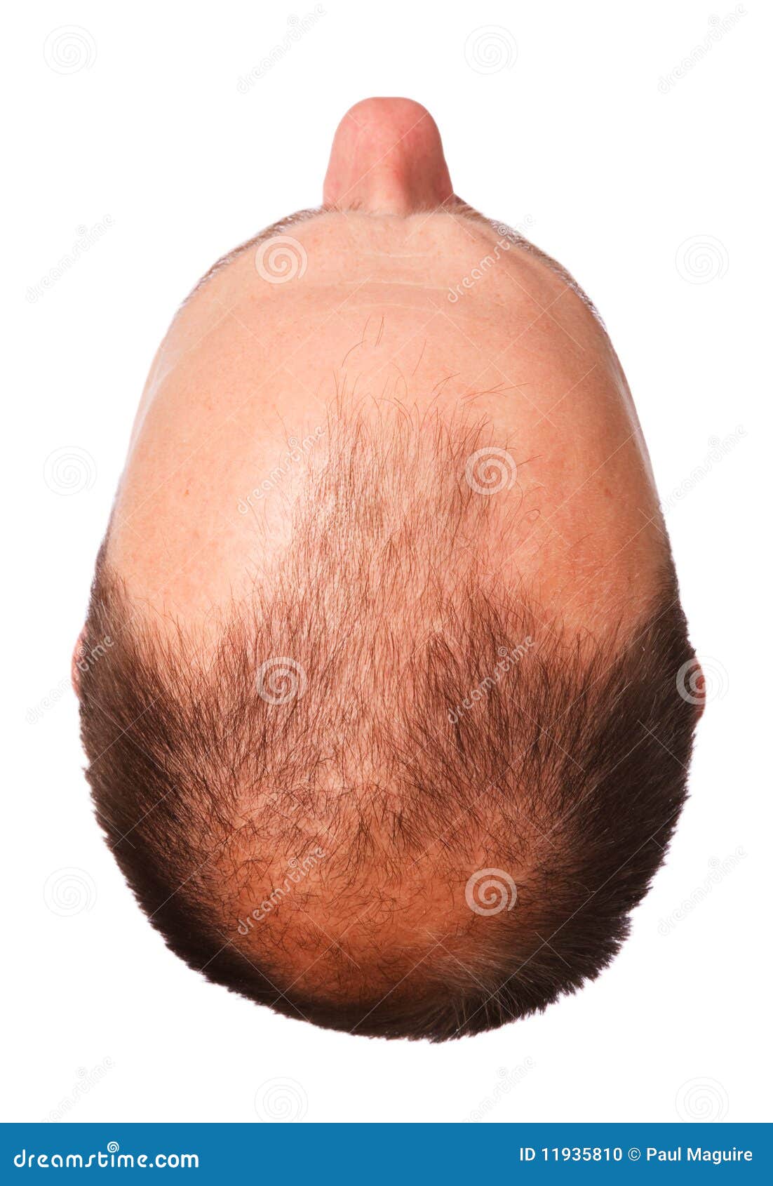 Male pattern baldness stock photo. Image of european - 11935810