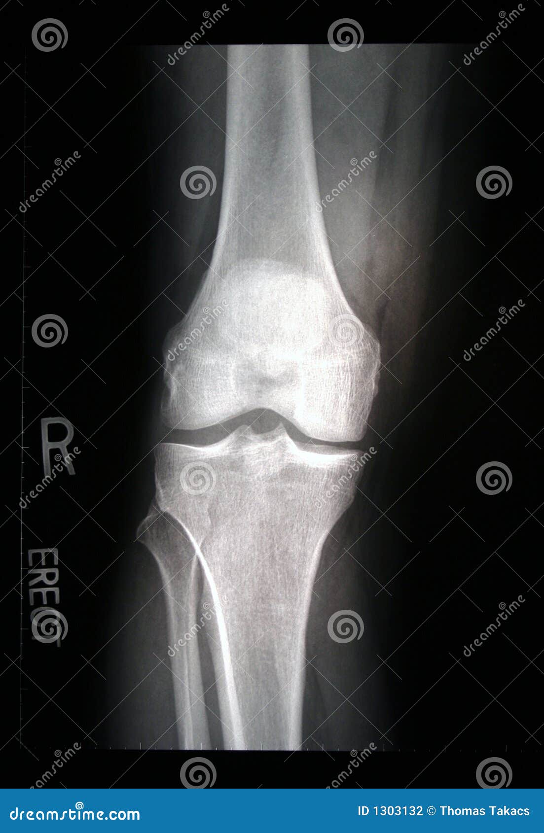 Male Right Knee stock photo. Image of joint, clinic, fibula - 1303132