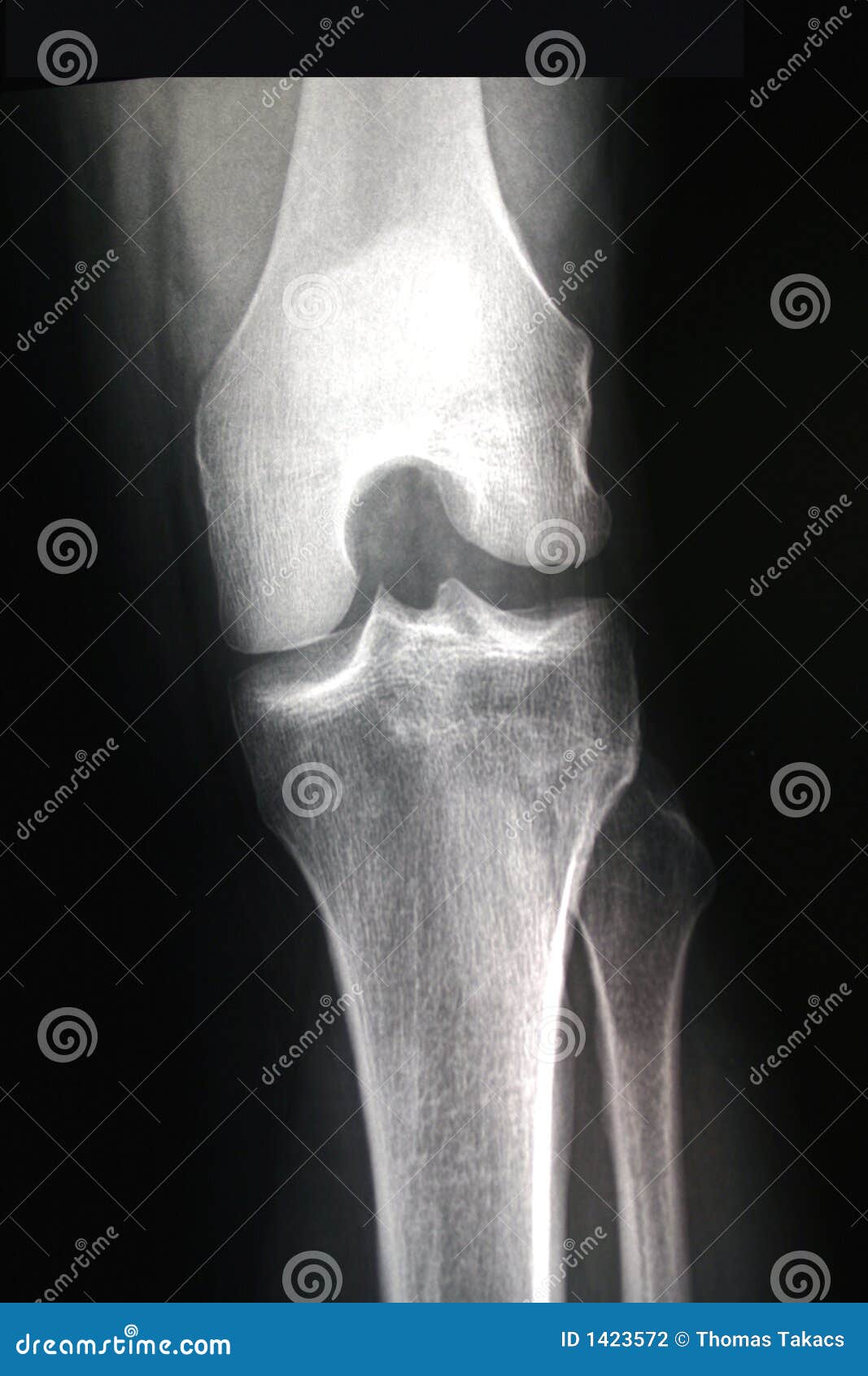 Male Right Knee - Bent stock photo. Image of disease, clinic - 1423572