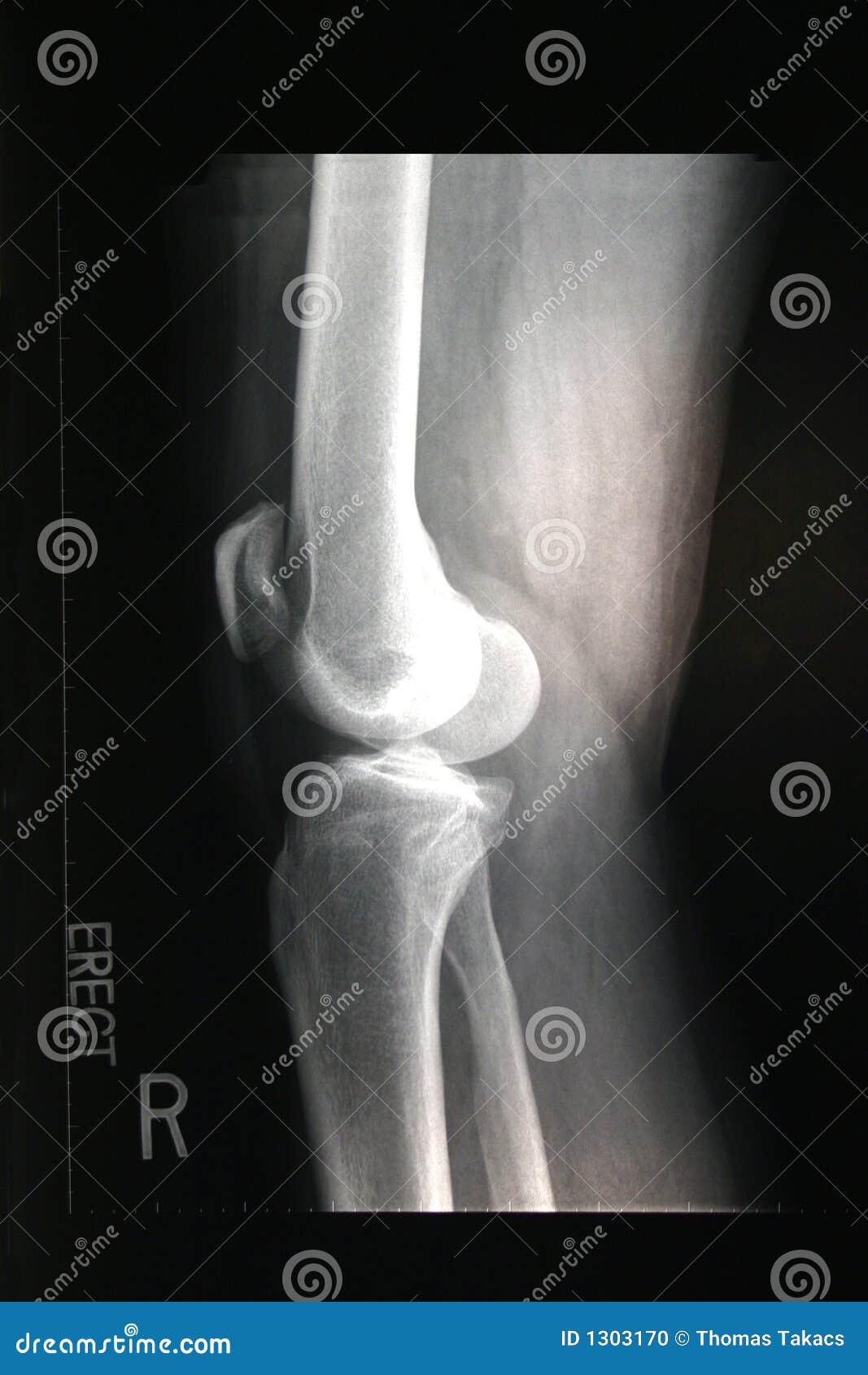 Male Right Knee - Side stock photo. Image of disease, knee - 1303170