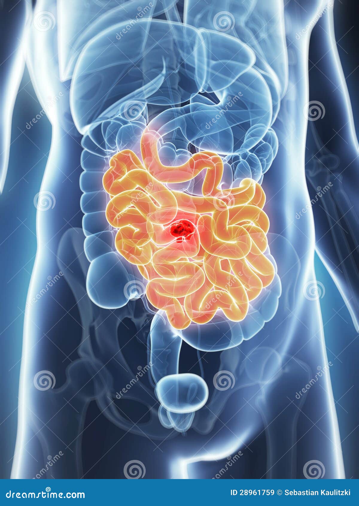 An Inflamed Small Intestine Royalty-Free Cartoon | CartoonDealer.com ...