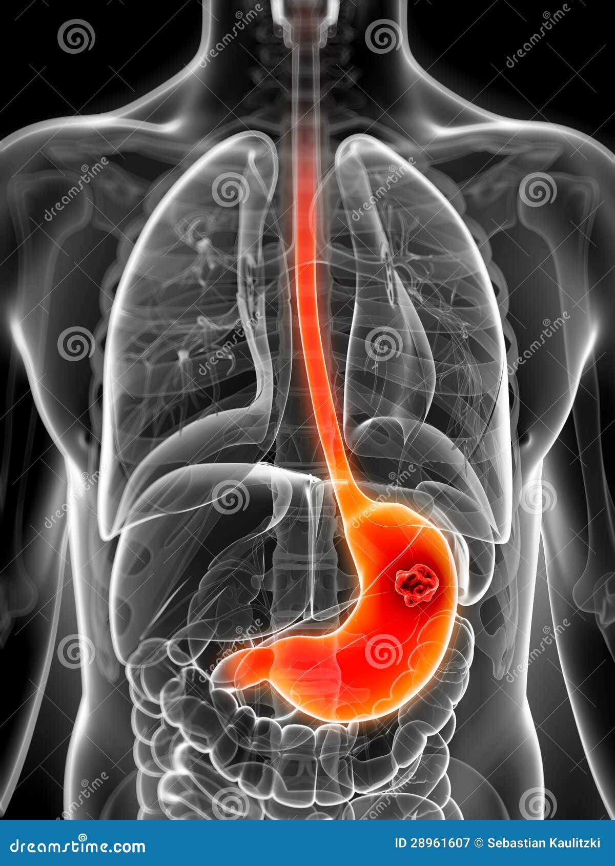 Stomach Cancer Line Color Icon. Human Organ Concept. Malignant Neoplasm ...