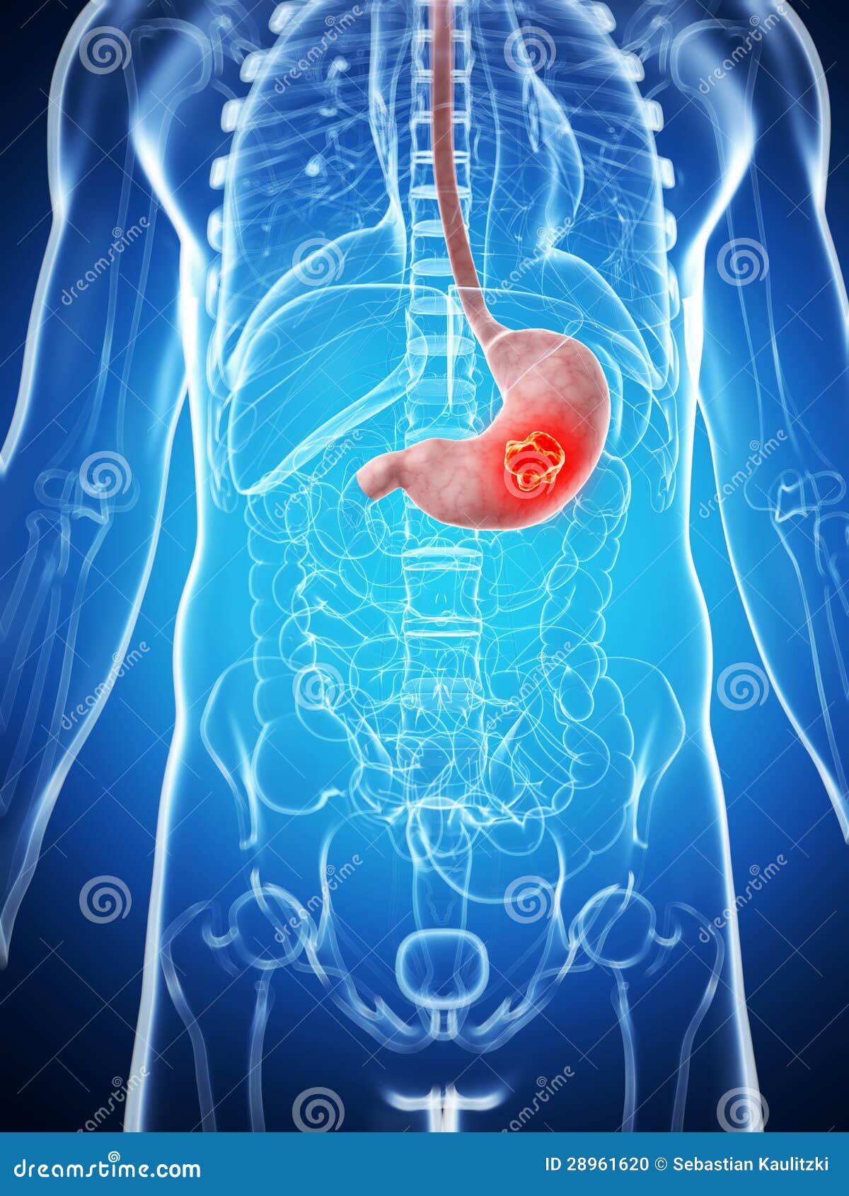 Stomach Cancer Operation Stock Photo | CartoonDealer.com #53027580