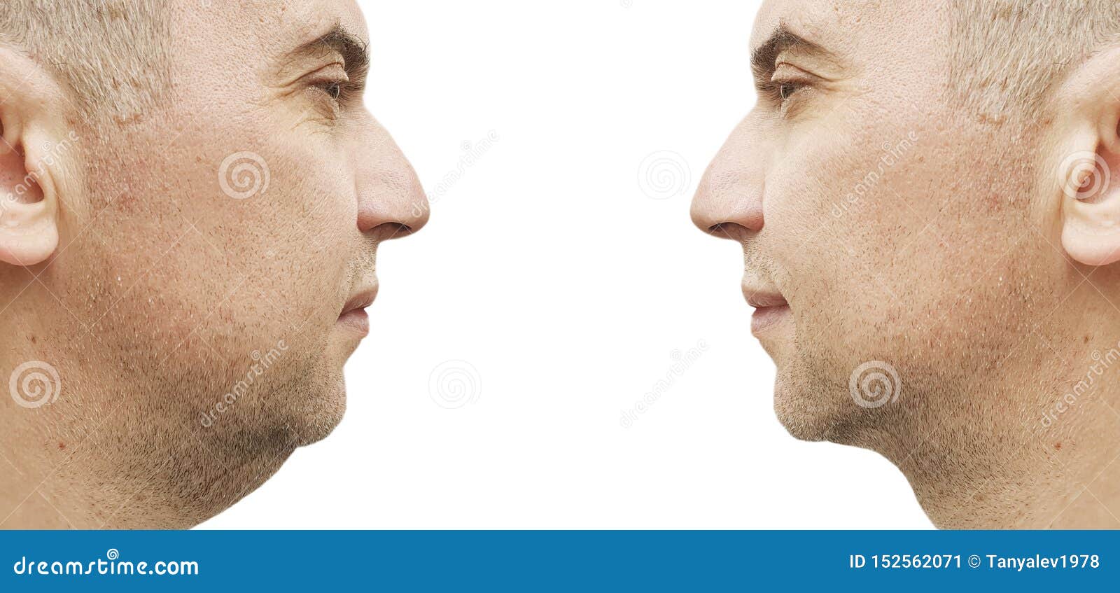 Male Wrinkles before and after Treatment Stock Image - Image of ...