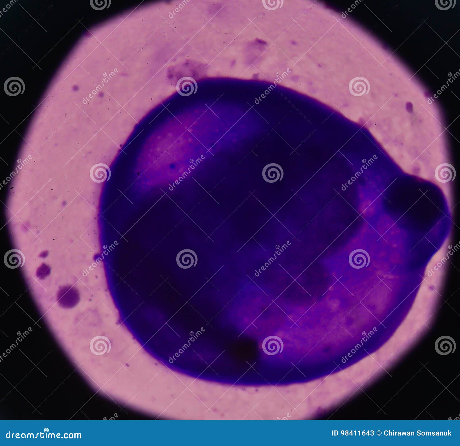 Malignant Cells in Pleural Fluid. Stock Image - Image of medical ...