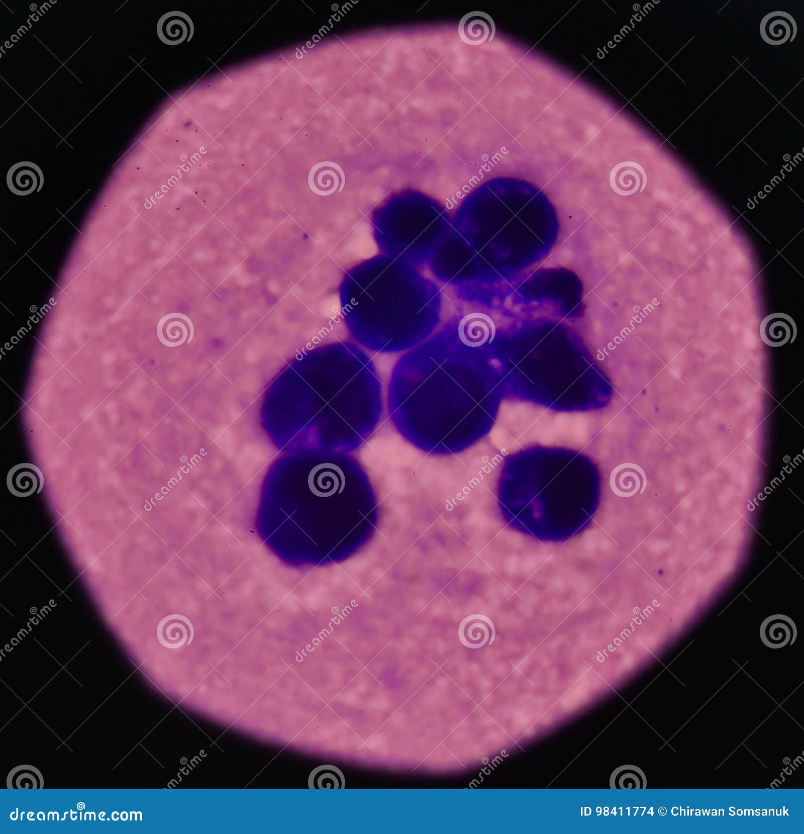 Malignant Cells in Pleural Fluid. Stock Photo - Image of human, cells ...