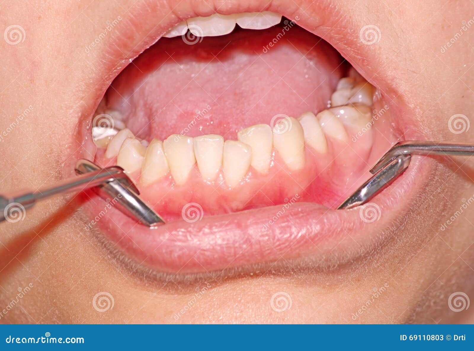 Malocclusion. Crowding of the Teeth Stock Image - Image of dentistry ...