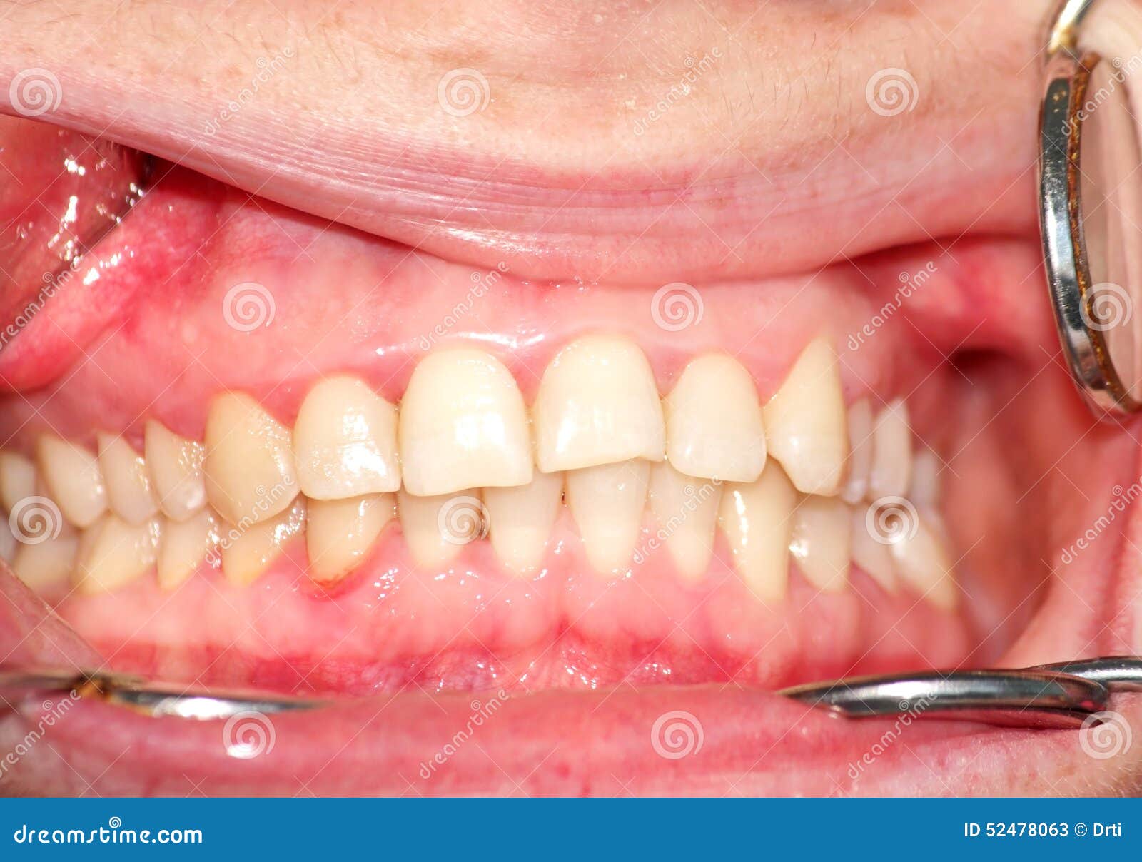 Malocclusion, Overcrowding Of Both Upper And Lower Teeth Stock Photo ...