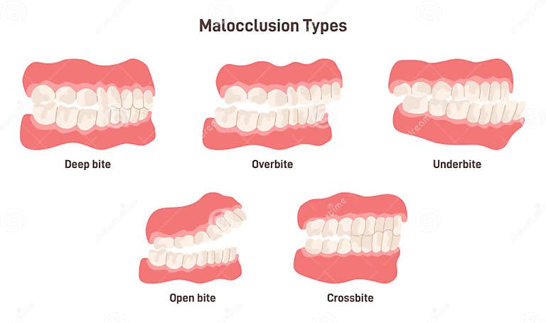 Malocclusion Types Set. Human Crooked Teeth Stock Vector - Illustration ...