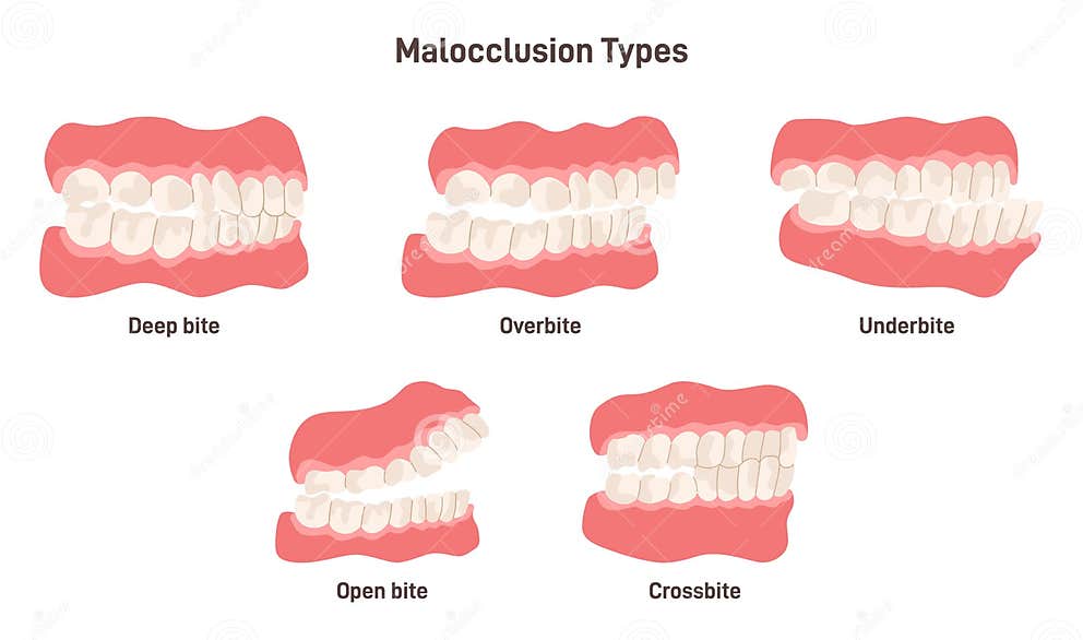 Malocclusion Types Set. Human Crooked Teeth Stock Vector - Illustration ...