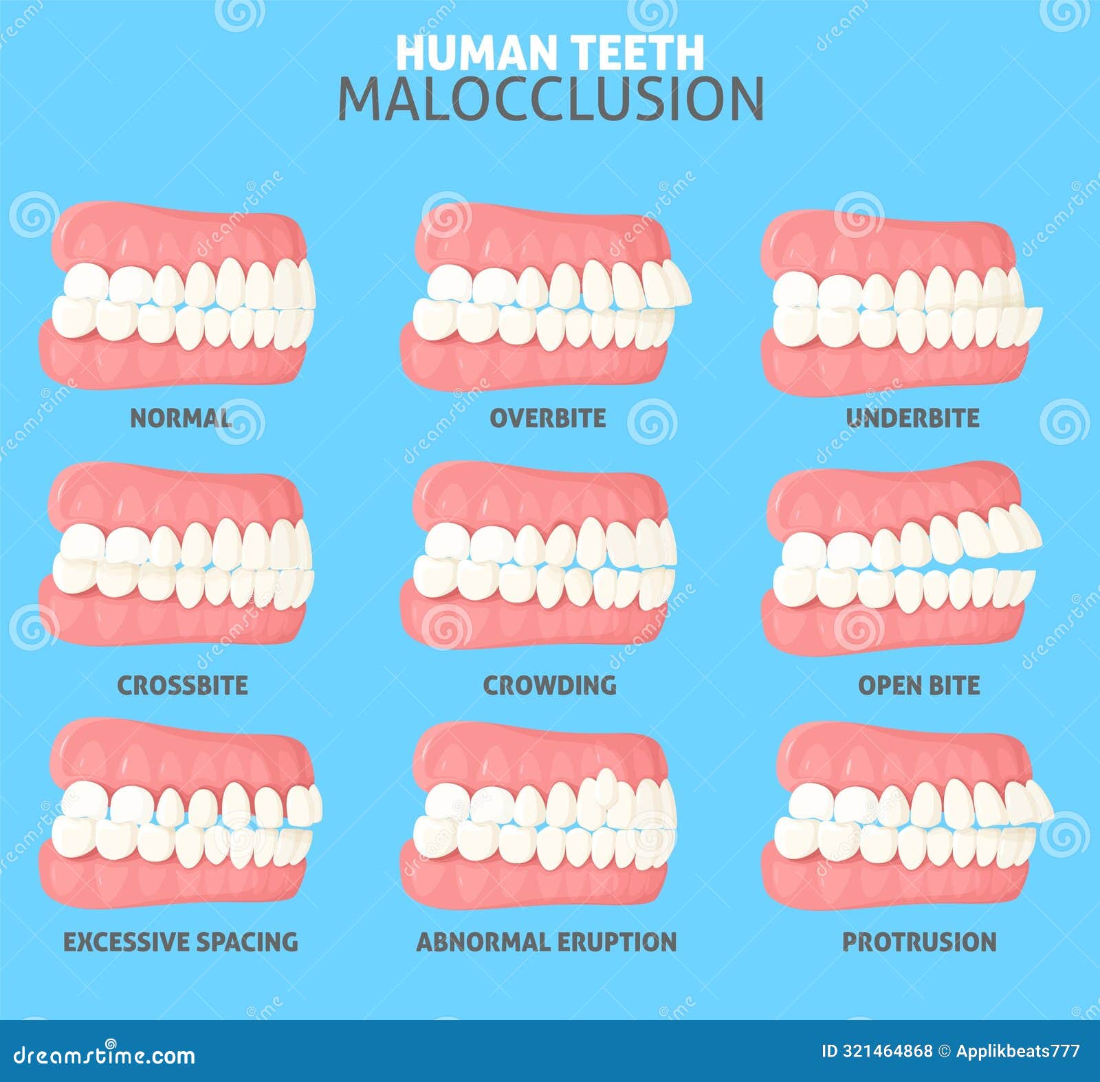 Malocclusion Types Side View Dentist Medical Poster Vector Illustration ...