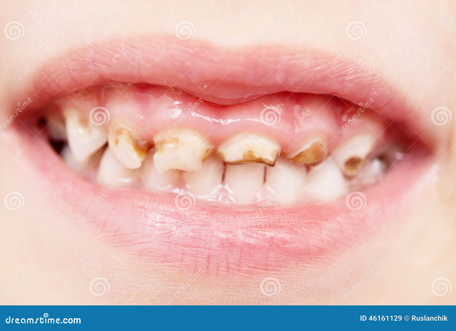 Malos dientes imagen de archivo. Imagen de putrefacto - 46161129