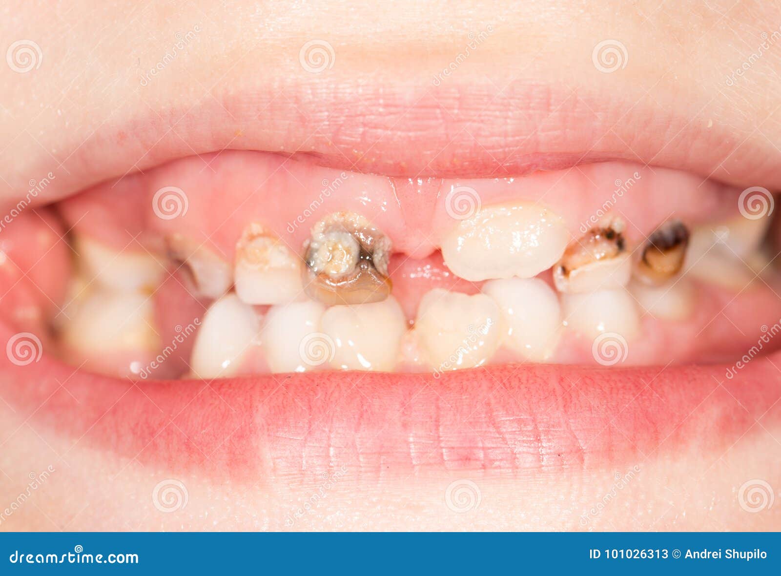 Malos Dientes En La Boca Primer Imagen de archivo - Imagen de salud ...