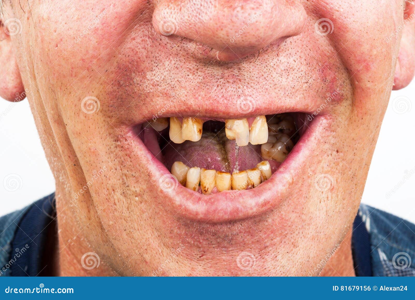 Malos dientes, fumador foto de archivo. Imagen de cavidad - 81679156
