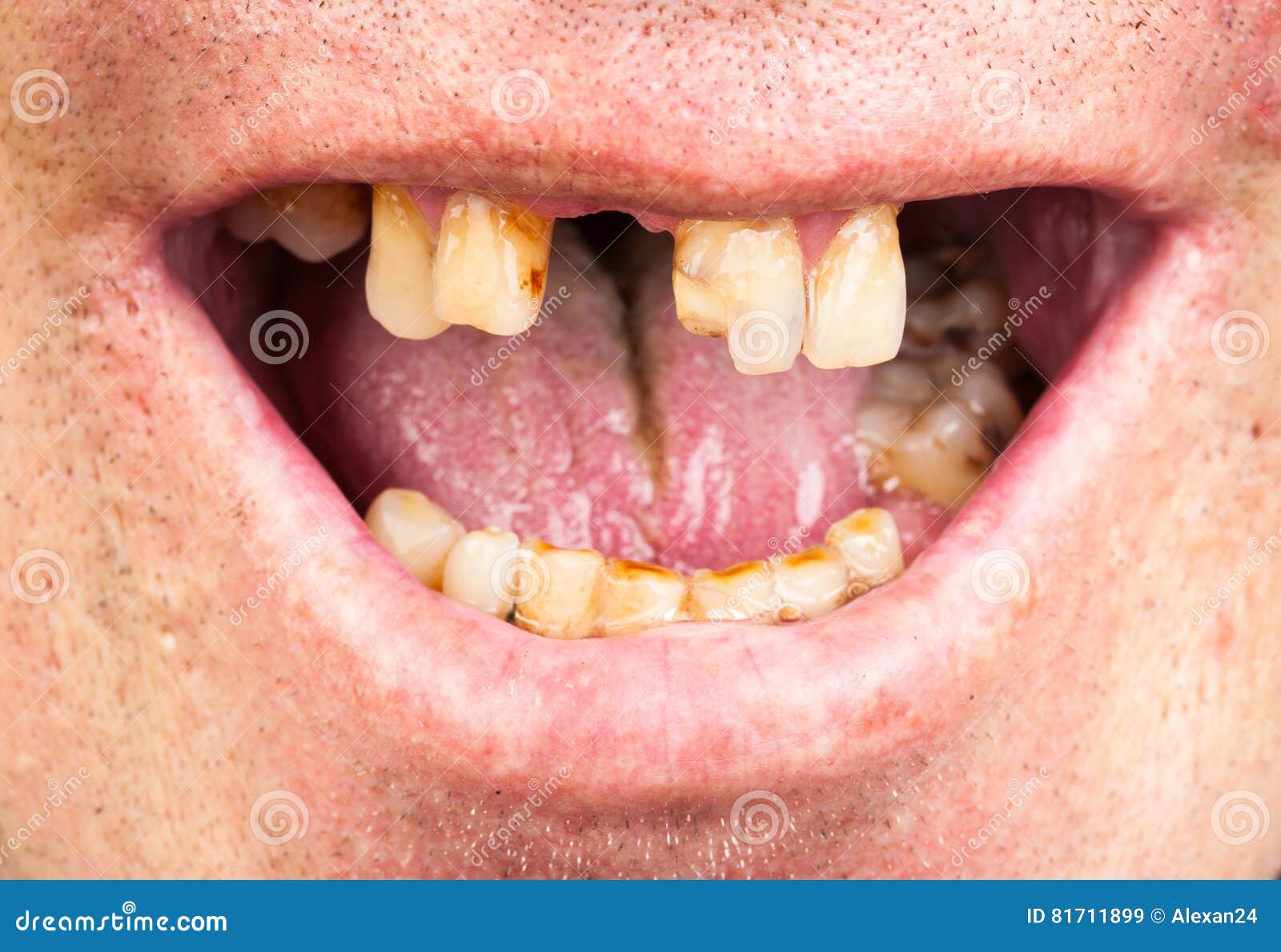 Malos dientes, fumador imagen de archivo. Imagen de tabaco - 81711899