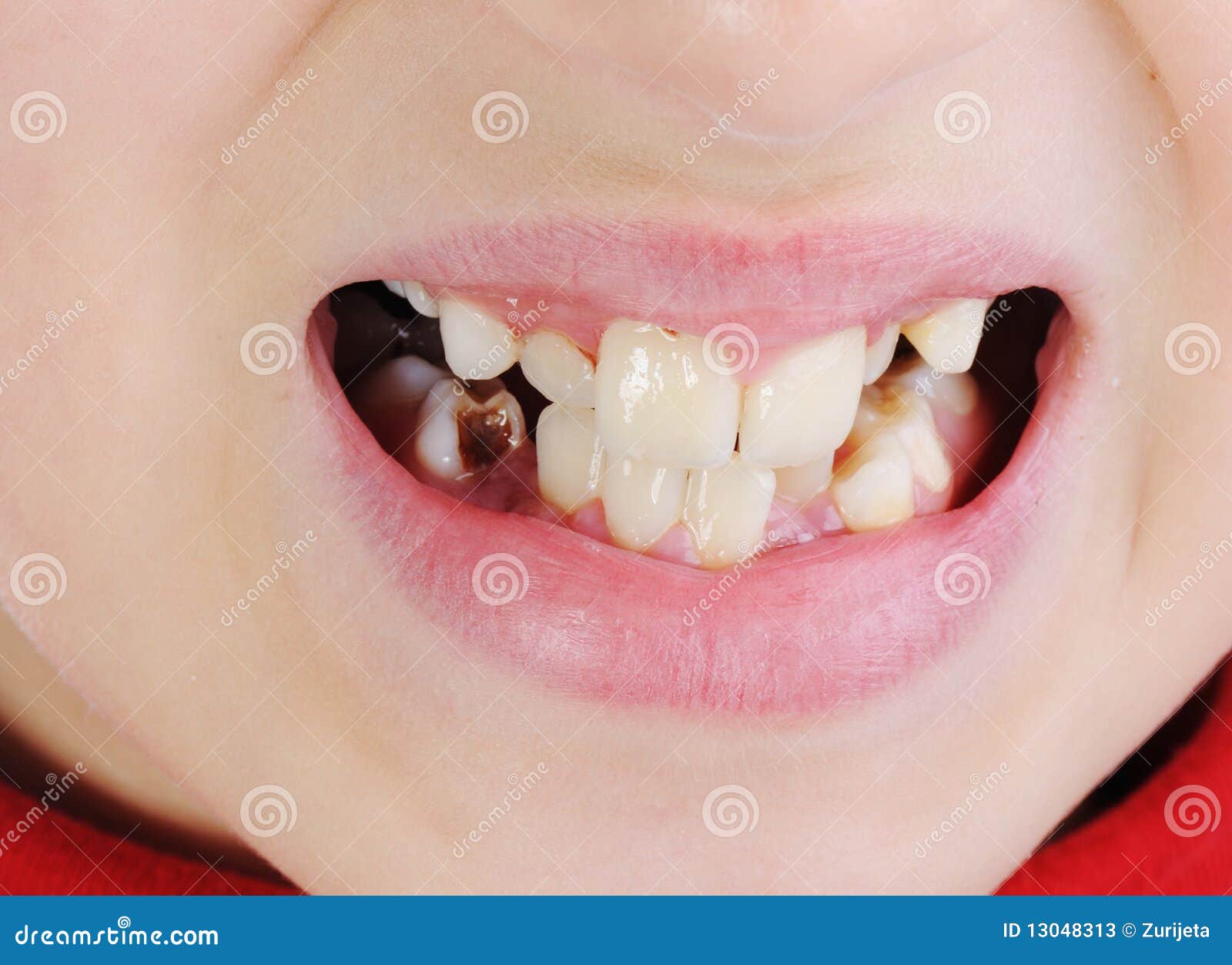 Malos dientes, primer imagen de archivo. Imagen de dentista - 13048313