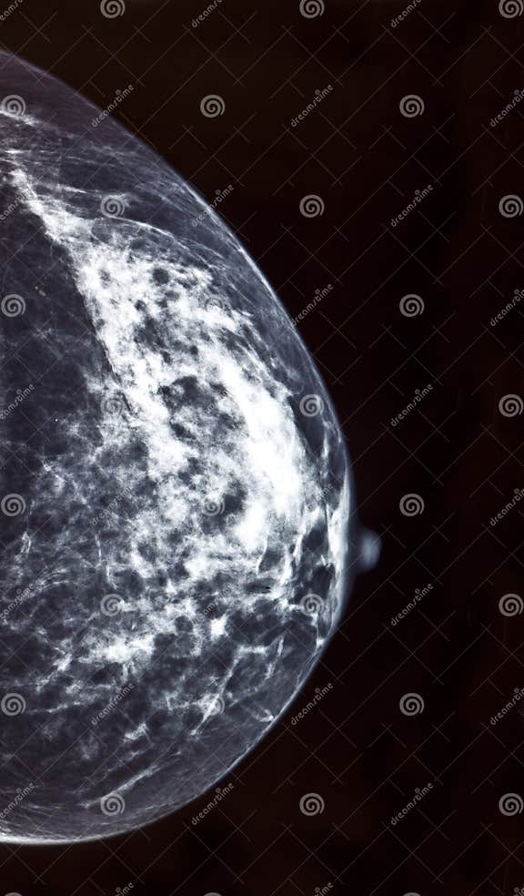 Mammogram stock photo. Image of vertical, mammogram, clinic - 70653514