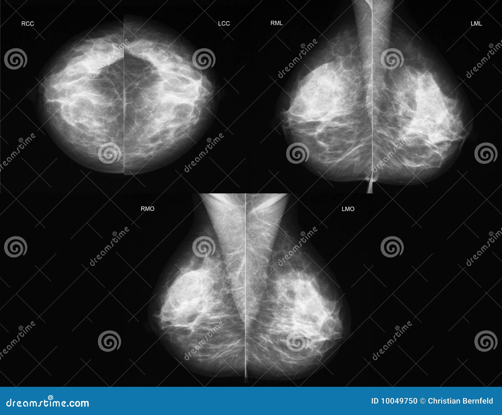 Mammography in All Projections Stock Photo - Image of checkup, digital ...