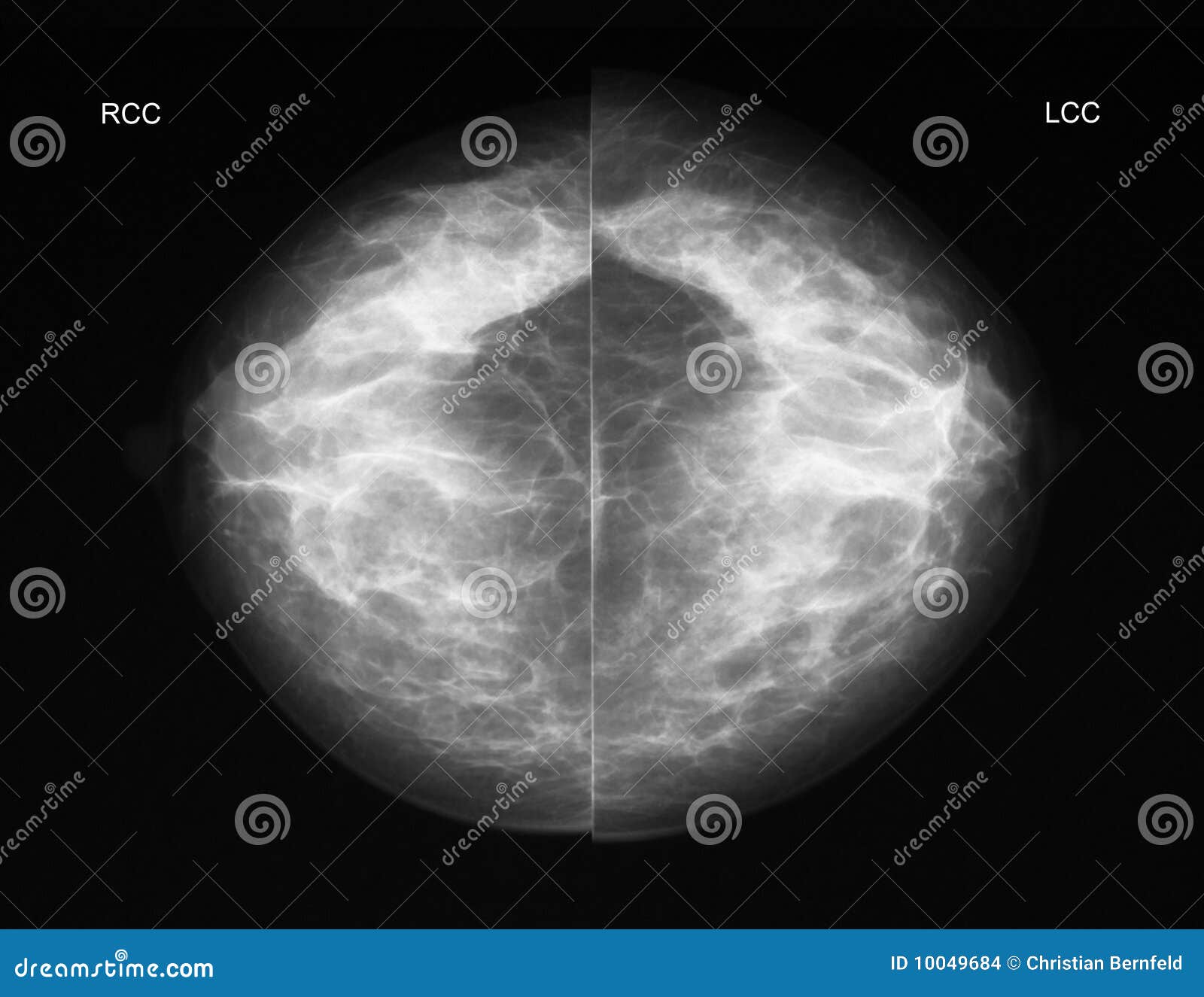 Mammography in CC Projection Stock Photo - Image of science, human ...