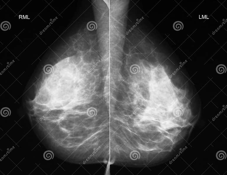 Mammography in Mediolateral Projection Stock Photo - Image of ...