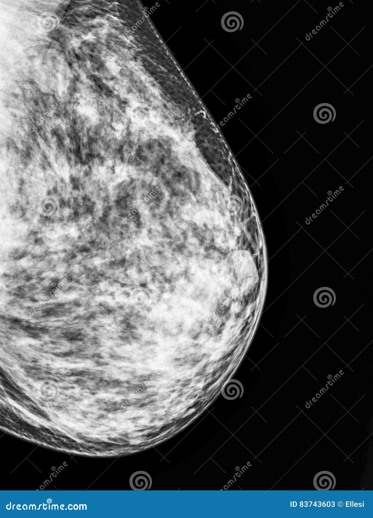 Mammography, X-ray of Breast Stock Image - Image of mammography ...