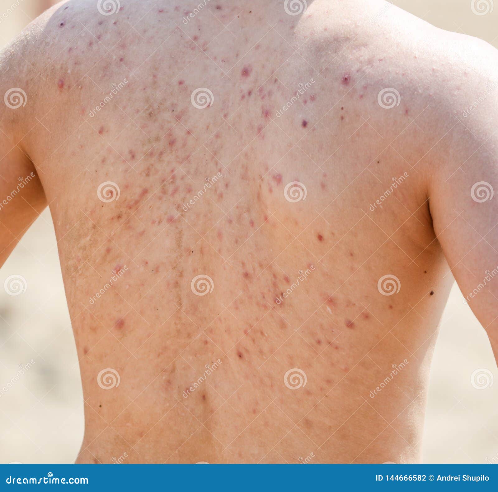 Man with acne on his back stock photo. Image of skin - 144666582