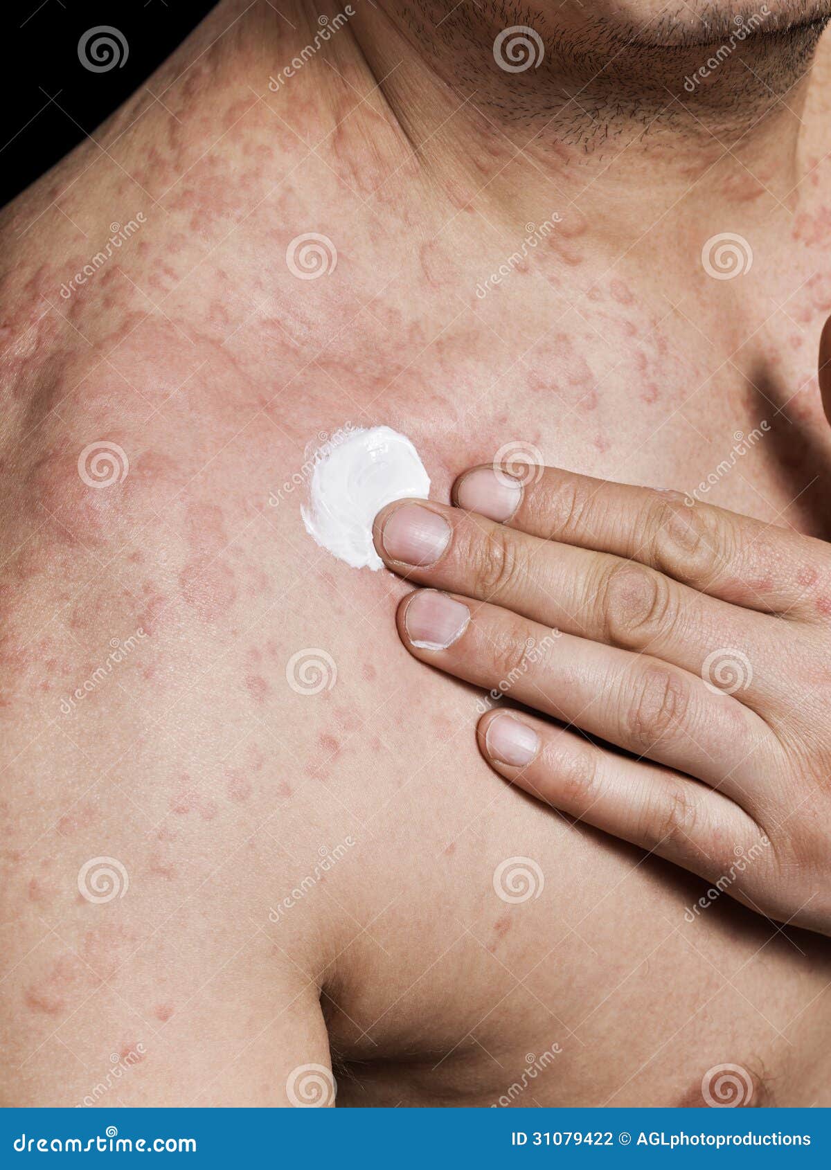 Man Applying Cream on Irritated Skin Stock Photo - Image of problems ...