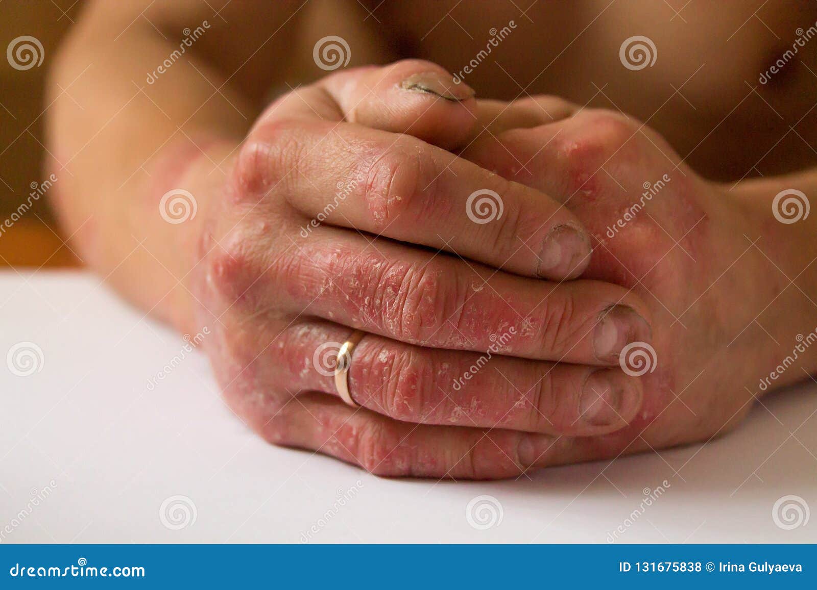 The Man on the Arm and Abdomen Spots Psoriasis Stock Photo - Image of ...