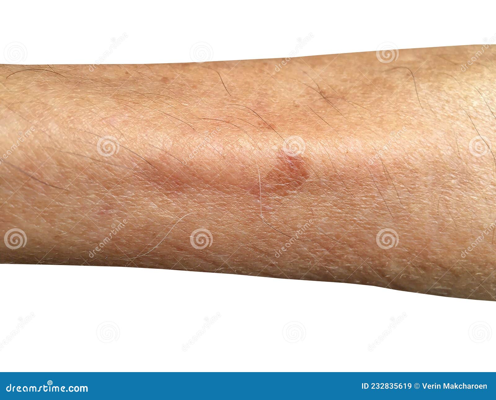 Arm Skin Freckles in the Elderly, Selective Focus Stock Image - Image ...