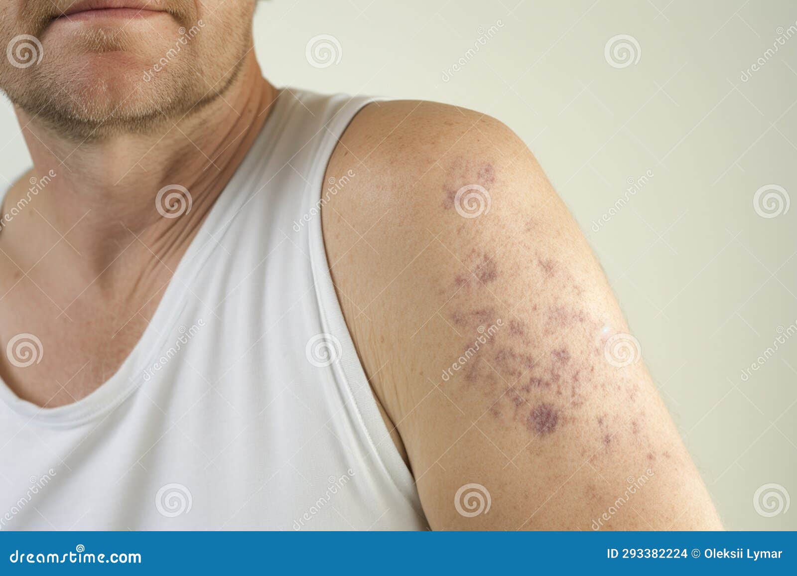 Skin Problem, Atopic Eczema Stock Photo - Image of discomfort ...