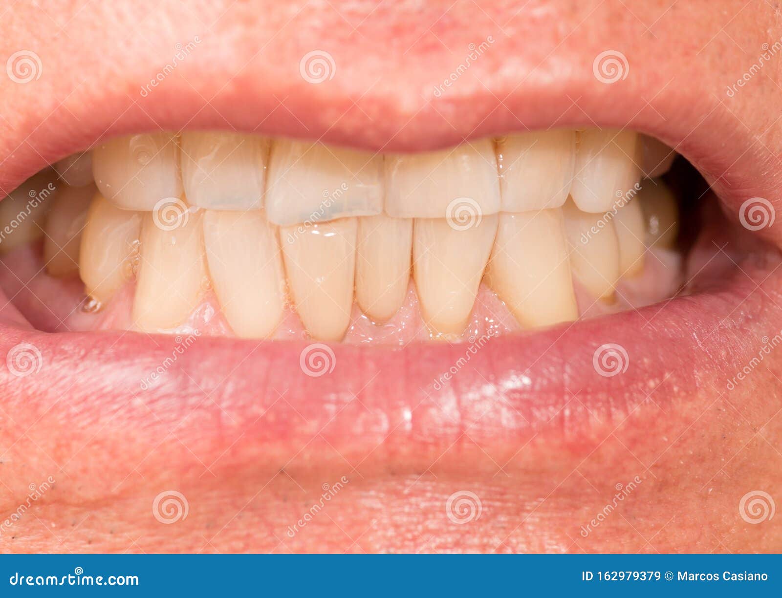 Man Biting Down on Front and Bottom Teeth Stock Image - Image of ...