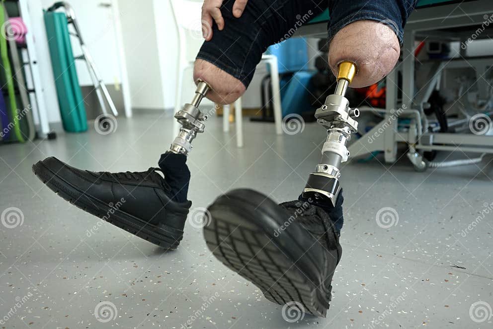 A Man with Bone-implanted Leg Prostheses. Osteointegration Stock Photo ...