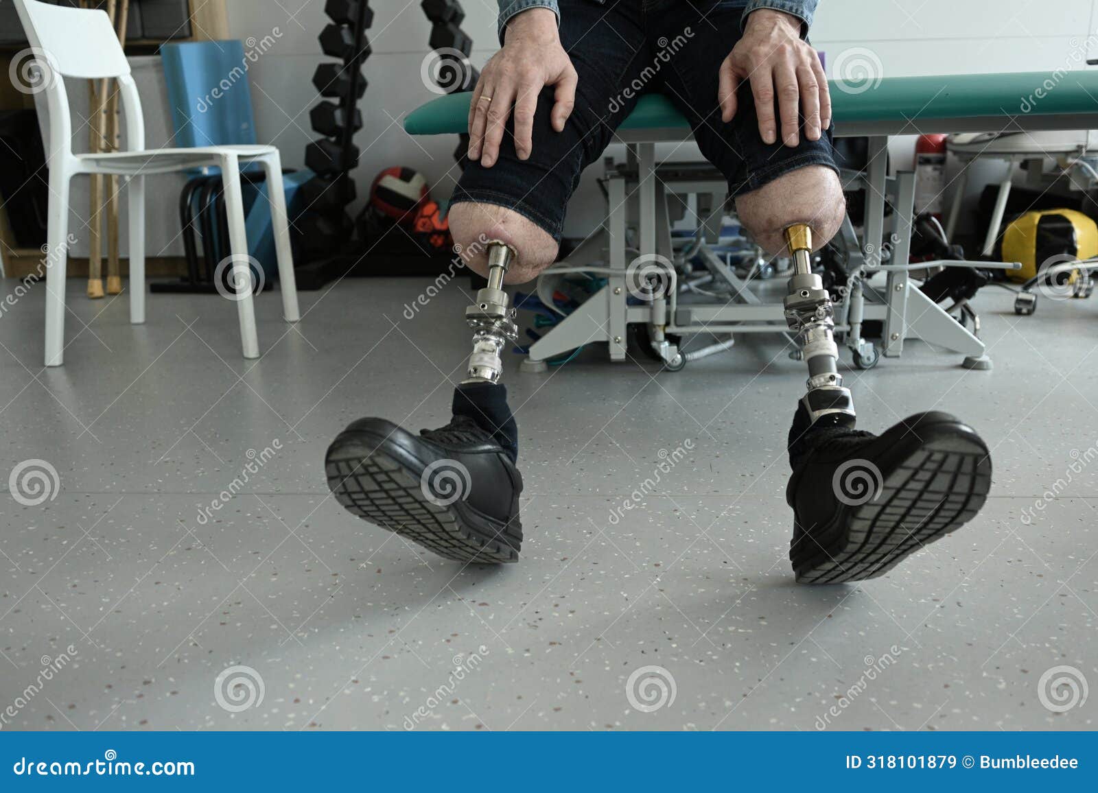 A Man with Bone-implanted Leg Prostheses. Osteointegration Stock Image ...