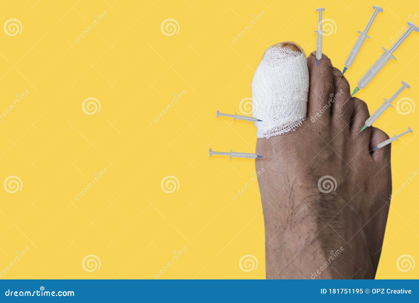 Man Broken Foot Or Broken Leg On Isolated Background Editorial Image